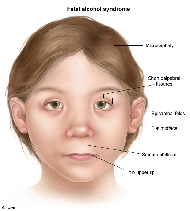 Fetal alcohol syndrome(FAS) 태아 알콜 증후군 : 네이버 블로그