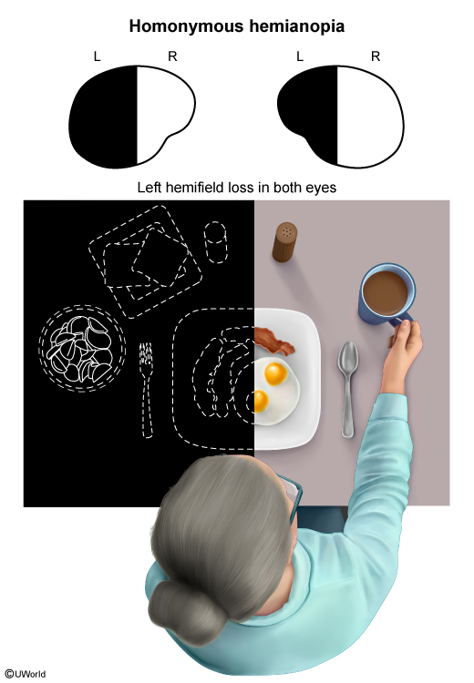 동측반맹(Homonymous Hemianopia) 증상 치료 시야 안과 간호 Unilateral neglect : 네이버 블로그